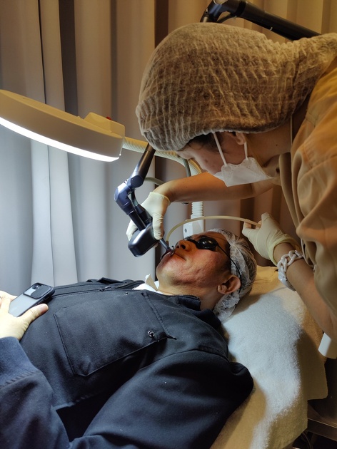 CO2 Pixel Laser Skin Resurfacing - Full