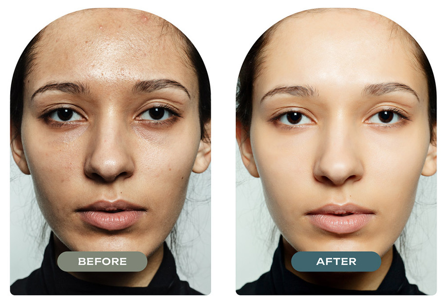 Genius™ RF MicroNeedling