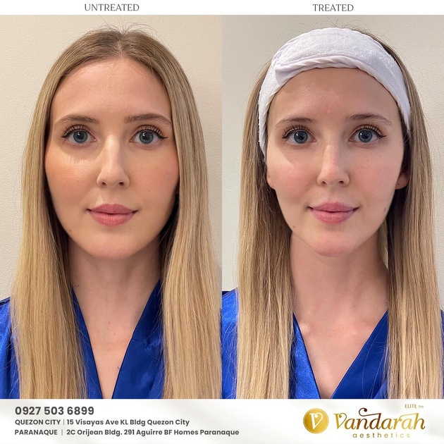 HIFU Lift Elite for Face + FREE HIFU for Eyes, V Contour Facial, Lipo ...