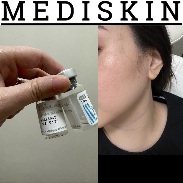 Jawtox, Traptox or Sweatox (1 Session)