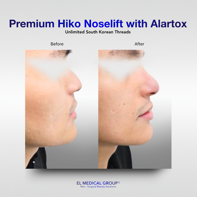 Premium Hiko Noselift with Alartox