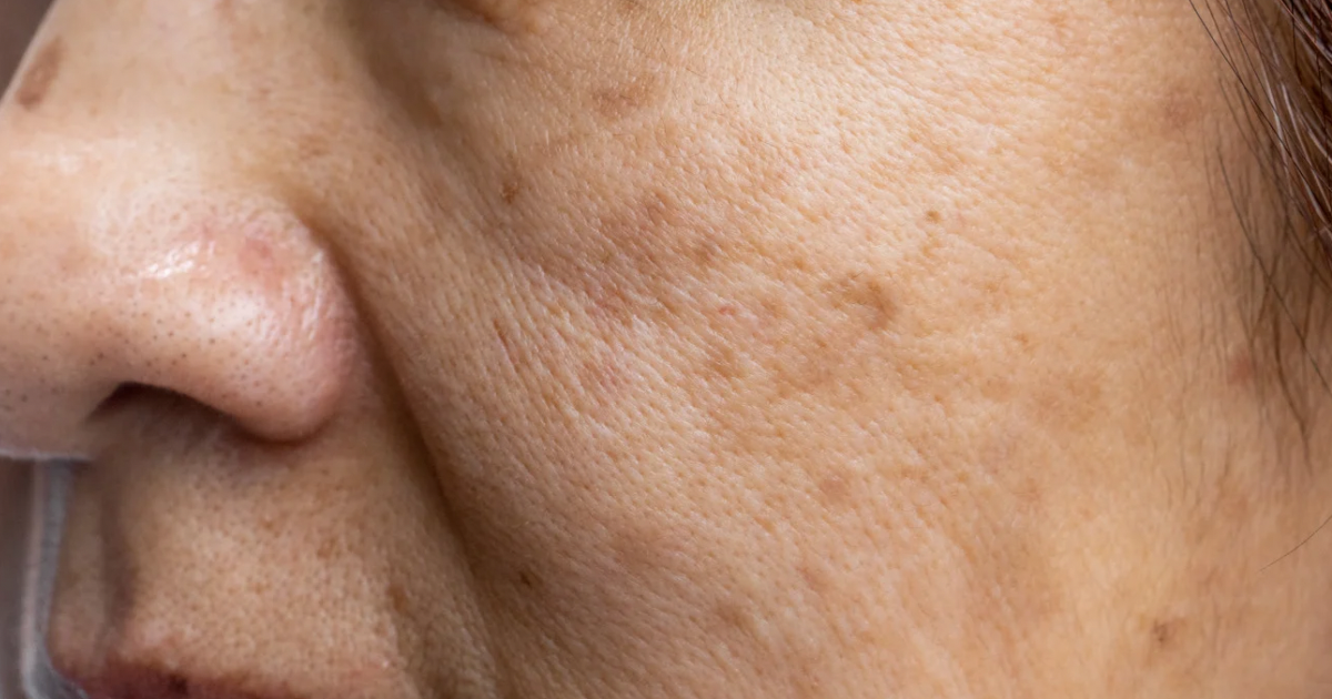 Melasma Laser Rejuvenation